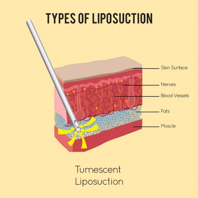 Liposuction in KL, JB, Malaysia - Get Your Excess Fat Sucked Out