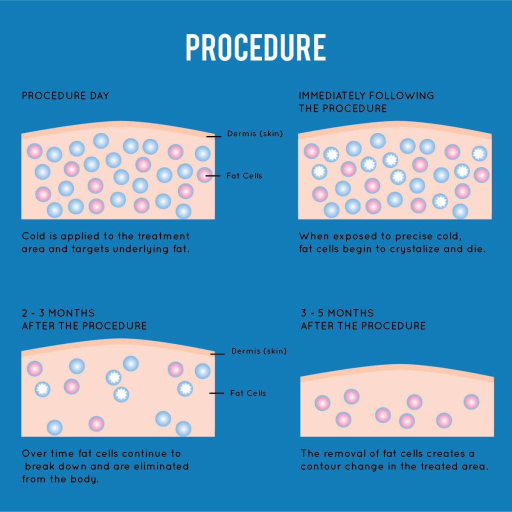 CoolSculpting®: Fat Reduction through Freezing - Beverly Wilshire Medical