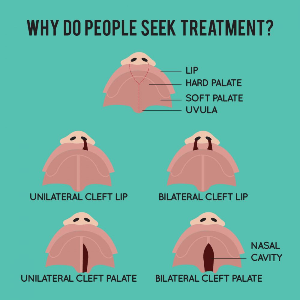 Cleft Lip & Palate - Beverly Wilshire Medical