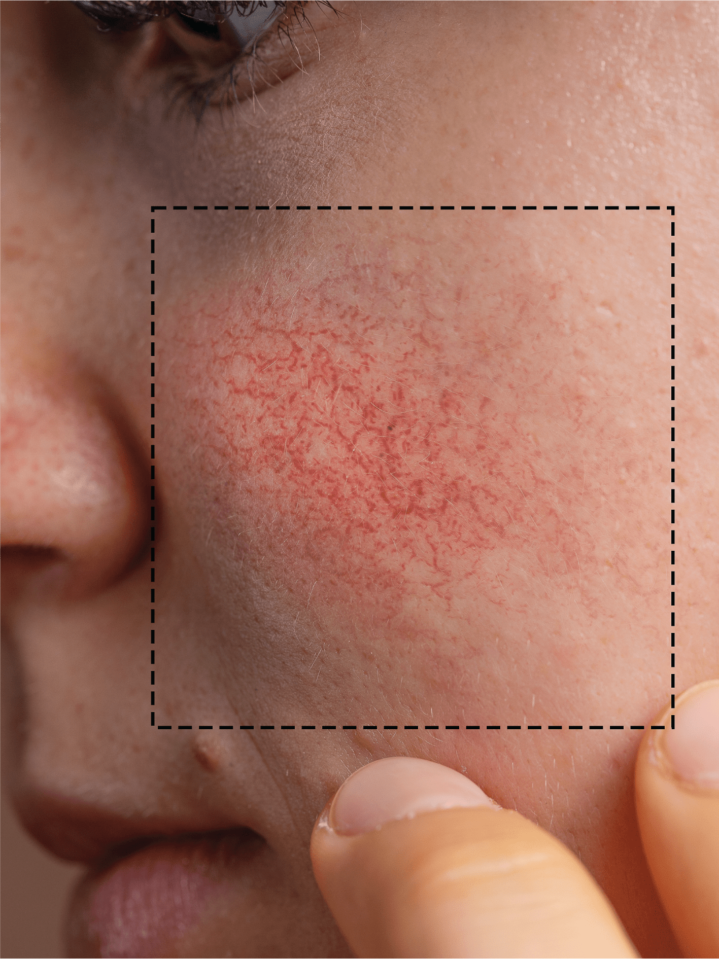 Rosacea & Eczema - Beverly Wilshire Medical